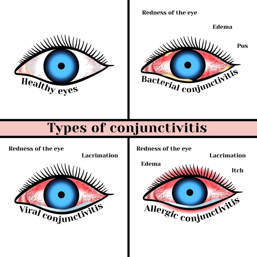 Eye Membrane Swelling Conjunctivitis (or Pink Eye) Is An Inflammation